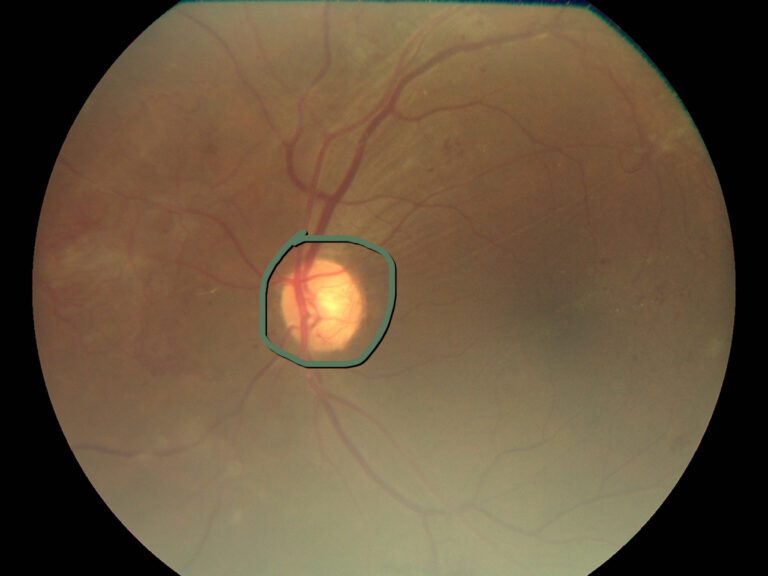 What is neovascularization of the disc or NVD? | Advanced Retina Care